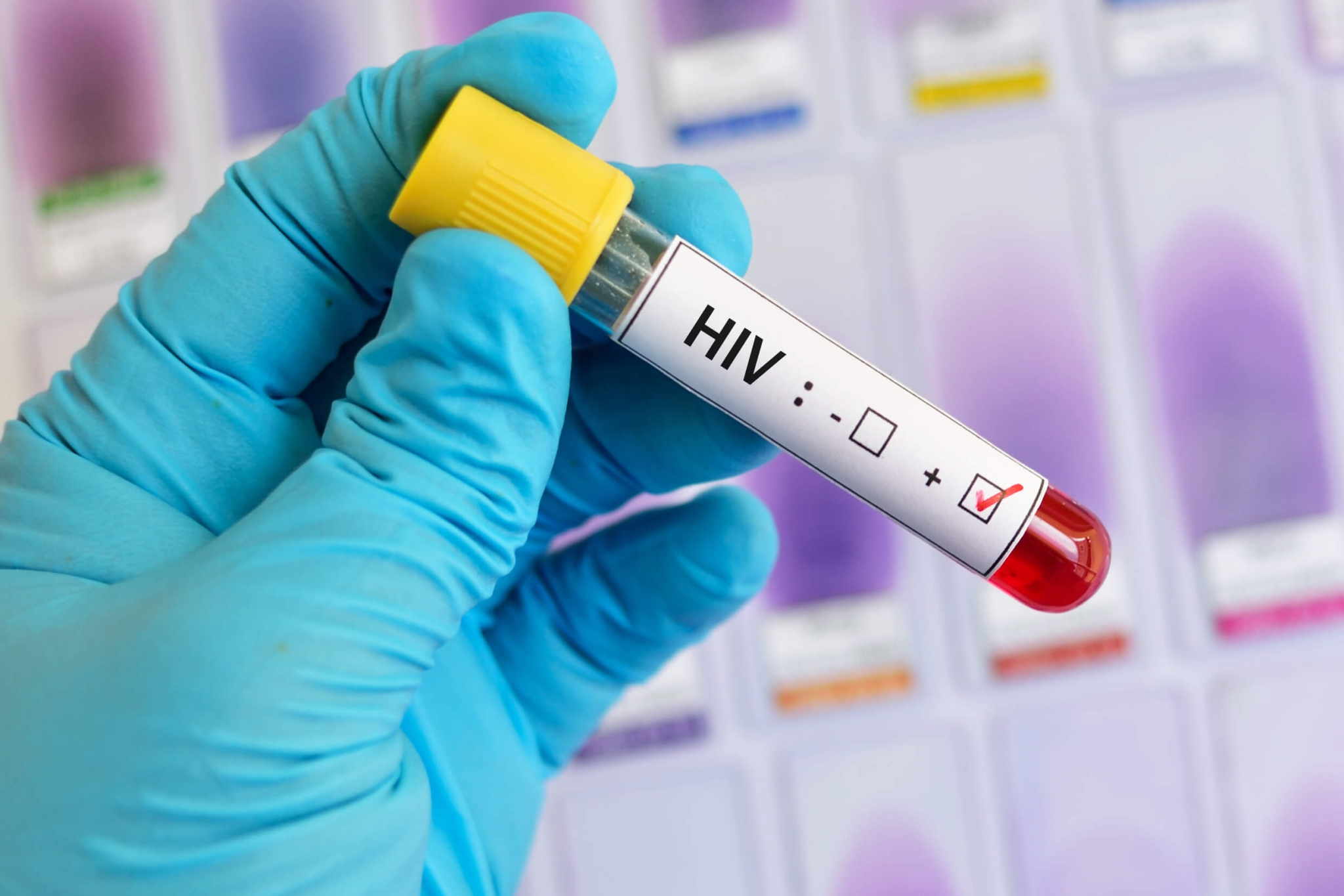 HIV: le cure ci sono e funzionano. Ma sono per pochi
