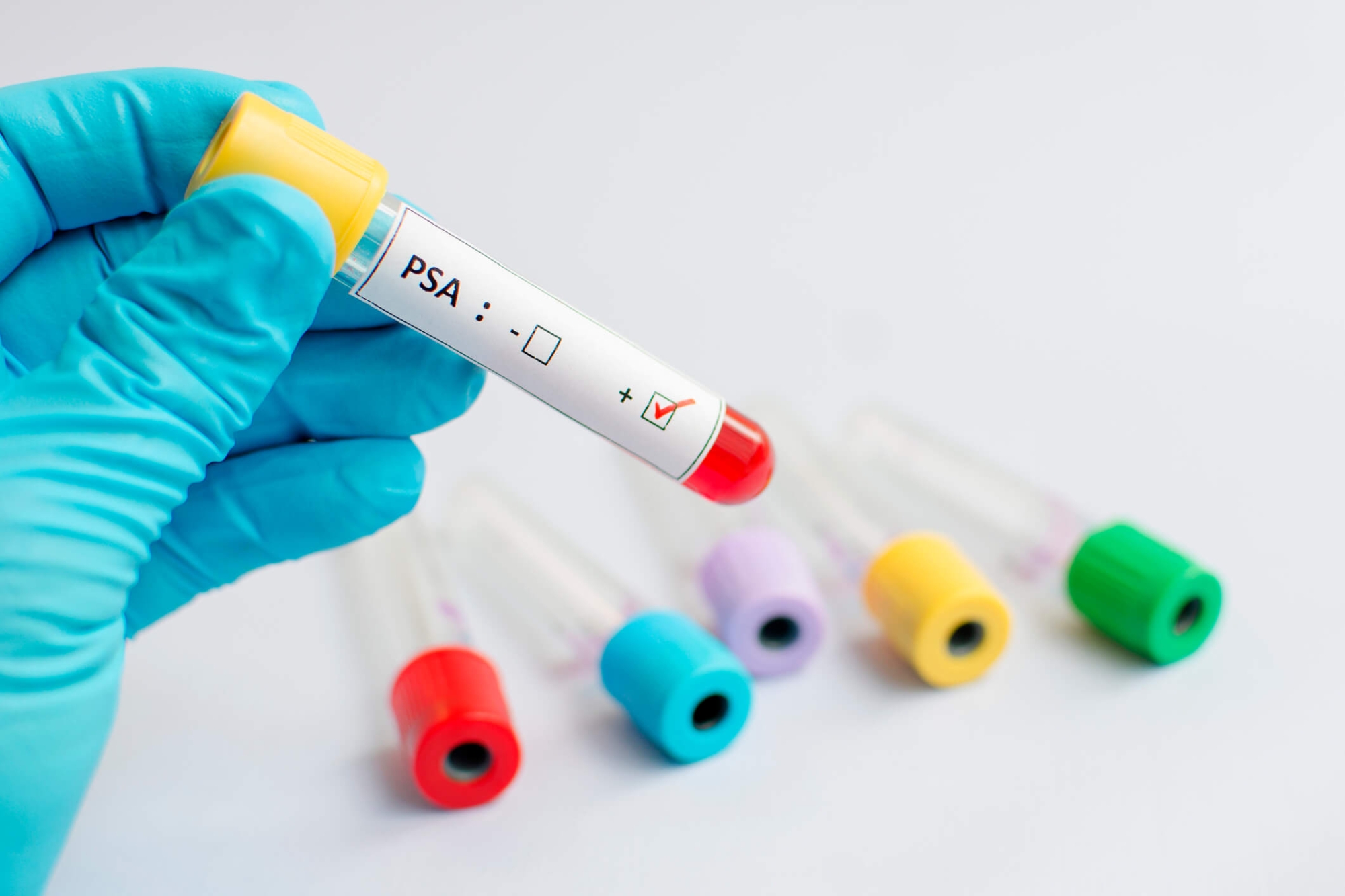 Il test del PSA è un esame di screening per il tumore alla prostata ...