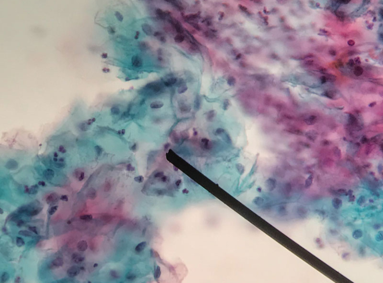 Ho avuto un papilloma sulla lingua, come proteggermi dall'HPV?