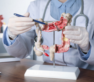 Tumore del colon: diagnosticarlo con un esame del sangue?